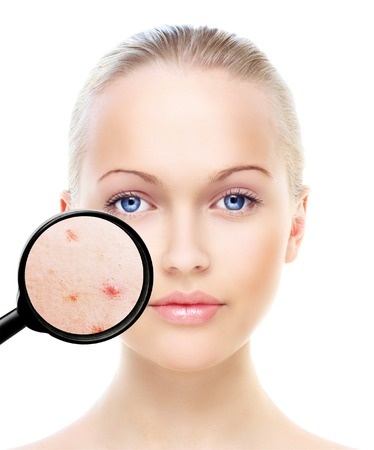 Acne treatments, aesthetics clinics, Southampton, Hampshire